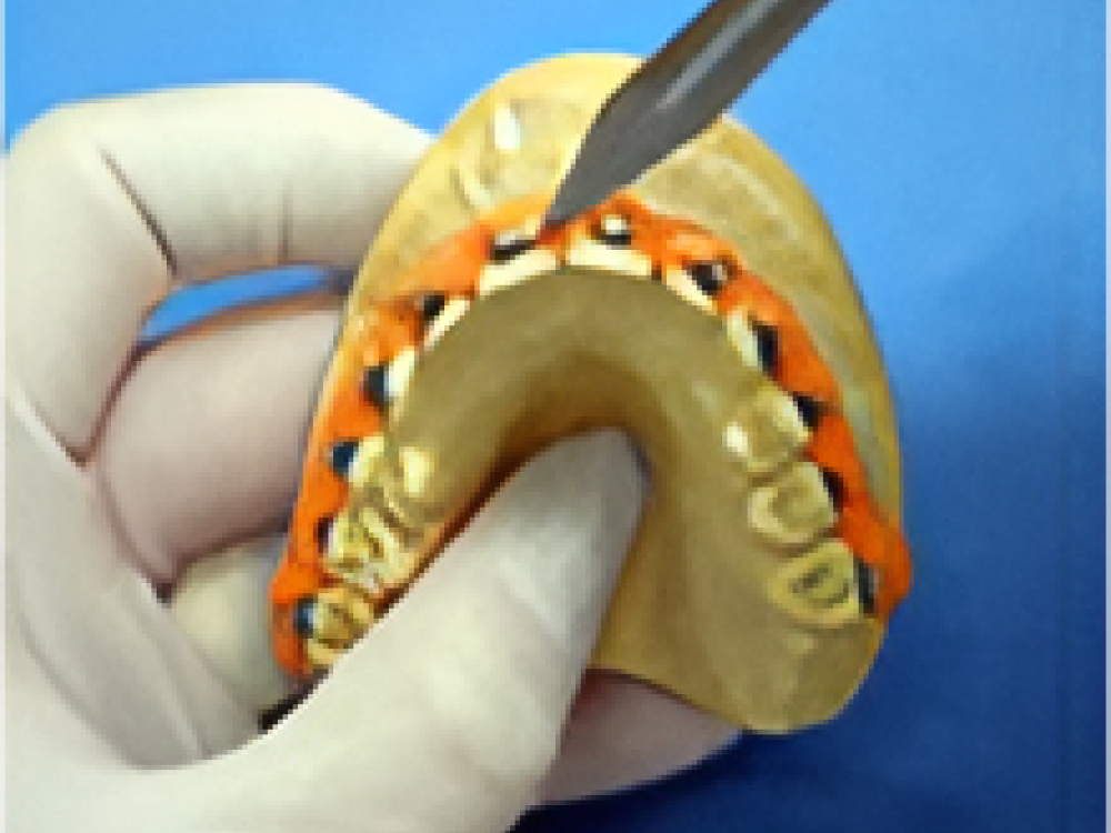 Indirect Bonding Explained | MOA St. Louis