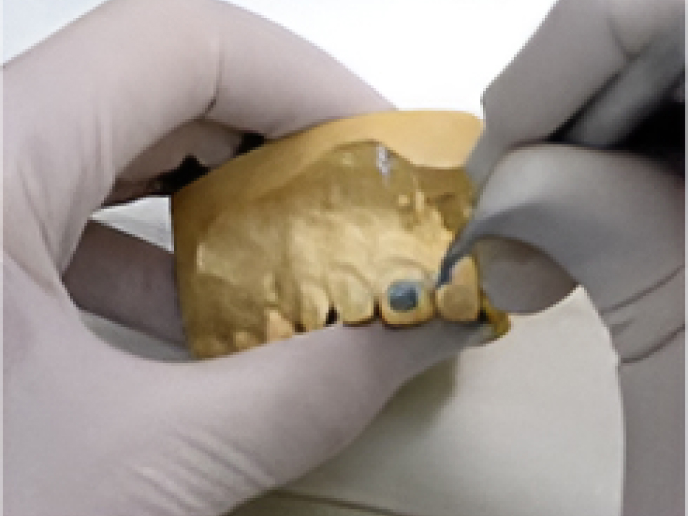 Indirect Bonding Explained | MOA St. Louis